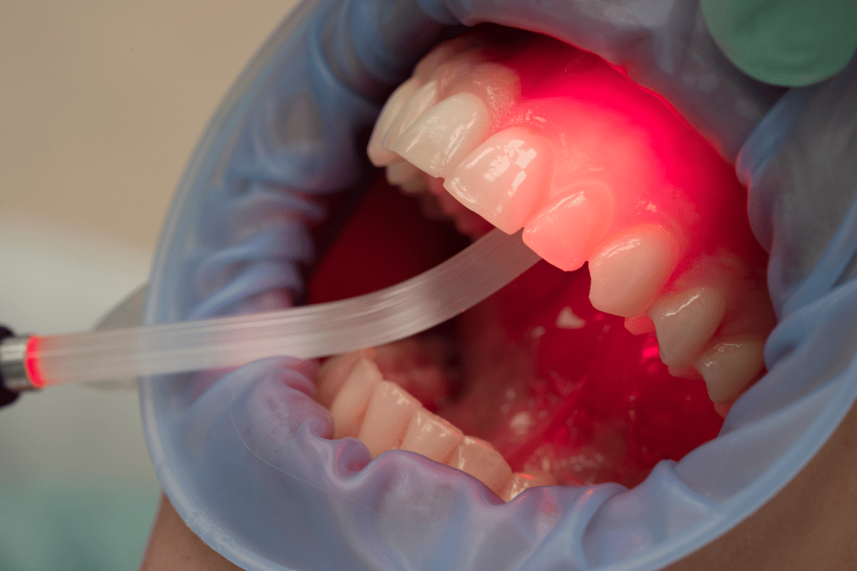 What Is Laser Gum Treatment And Do I Need It? | Valley Dental Spa
